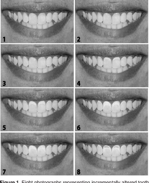 Figure 1 From Do Various Degrees Of Tooth Decalcification Affect