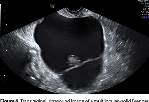 Figure 2 From Brenner Tumor Of The Ovary Ultrasound Features And