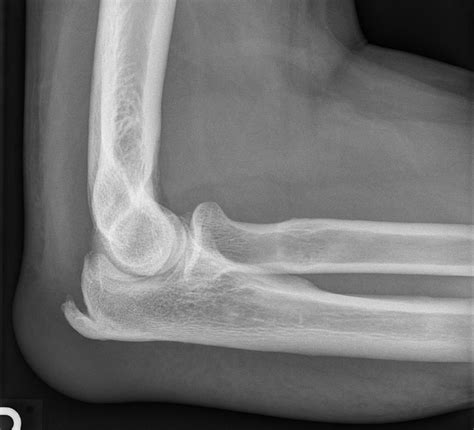 What Is Bursitis And How Does It Affect The Body Back To Motion Denver Physical Therapy