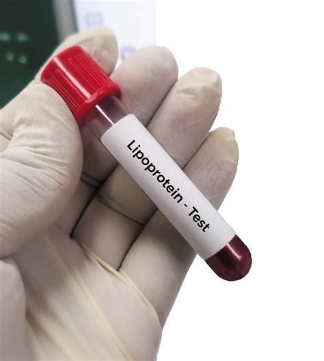 Lipoprotein A An Update On Testing And Treatment Harvard Health