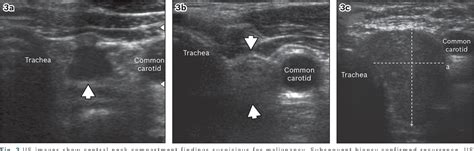 Figure 2 From Post Thyroidectomy Neck Ultrasonography In Patients With