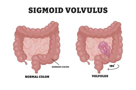Sigmoid Volvulus Vs Normal Colon Medical Diagram Educational Medical Poster Design Healthcare