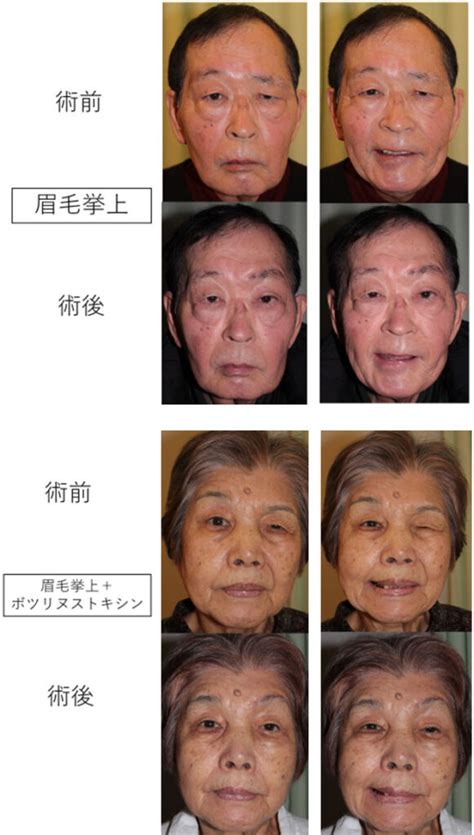 顔面神経麻痺後遺症の治療 形成外科・小児形成外科 外科系診療科 診療科・部門 淀川キリスト教病院