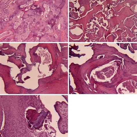Trabecular Bone Made Up By Remodeling With Reactive Bone Formation A