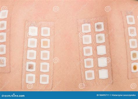 Allergy Test Stock Image Image Of White Kite Woman 98495711