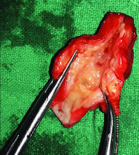 Longitudinal Cut Open Section Of The Appendix Showing Three Openings Of