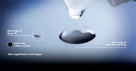 Idose® Glaucoma Treatment Long Term Relief