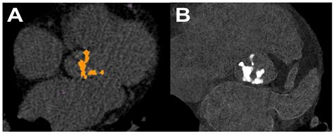 Dual Energy And Photon Counting Computed Tomography In Vascular Applications—technical