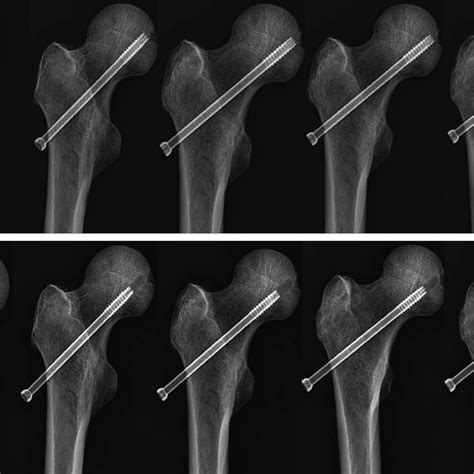 Otaao Classification Of Femoral Neck Fractures Download Scientific Diagram