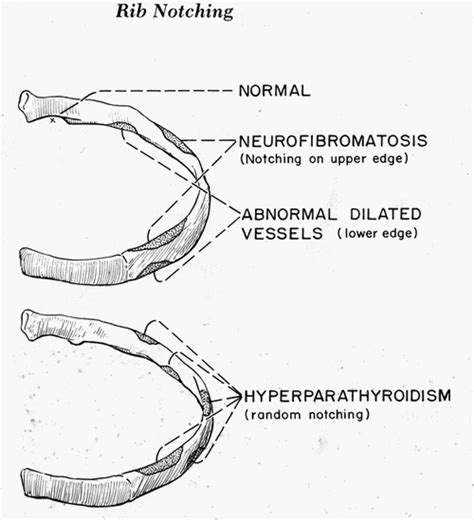 Rib Notching Epomedicine
