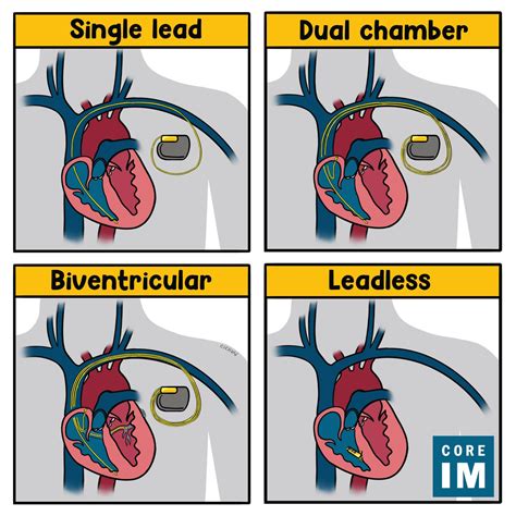 Types Of Pacemakers For The Heart