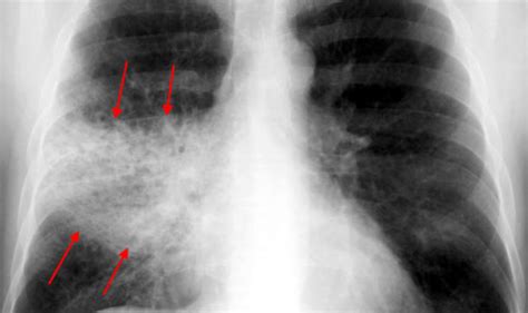 Clinical Frailty Scale Cfs Lægenoter