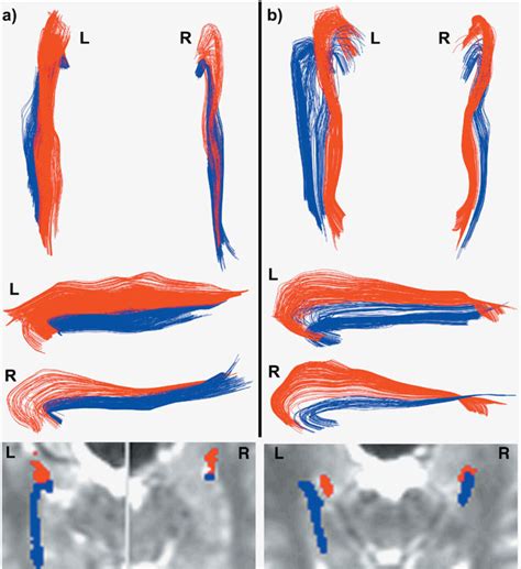 Amygdalo Fusiform Red And Hippocampo Fusiform Blue Pathways For A