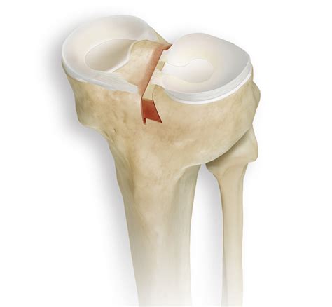 Arthrex Dovetail Meniscal Allograft Set