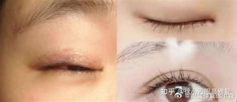 张菡 双眼皮术后眼睛闭合不全是什么原因？ 知乎