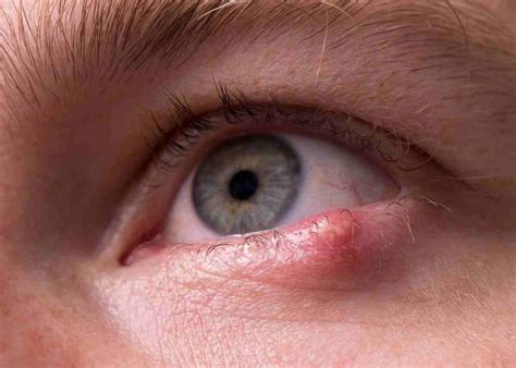 Eyelid Cyst Light Yellowish Cystic Nodule Near The Punctum In The