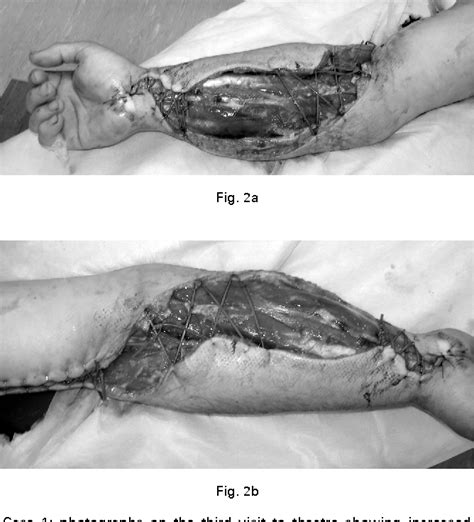 Figure 1 From Subcutaneous Anthrax In Three Intravenous Drug Users A