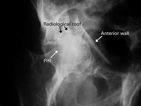 Fractures Of The Acetabulum In Patients Aged 60 Years And Older Bone
