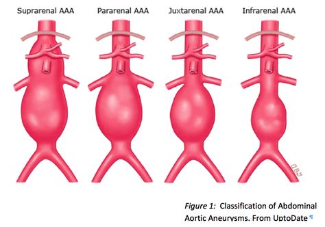 How Big Is An Aortic Aneurysm At Rene Neal Blog