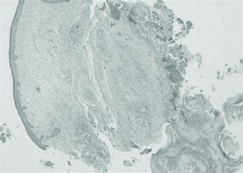 H And E ° ø 40 A Relatively Sharply Demarcated Nodule In The Lower