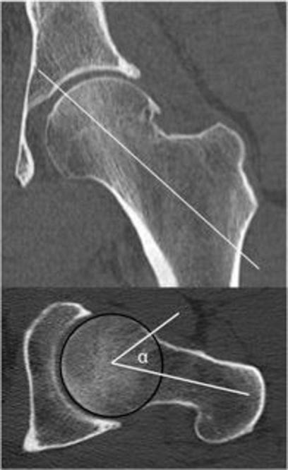 Figure 1 From Discrete Mineralisation Of The Acetabular Labrum A Novel