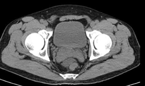 The Second Abdominal Ct That Is Showing A Small Number Of Ascites In