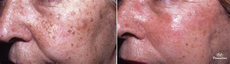 Queratosis Seborreica Facial Dermaclinic