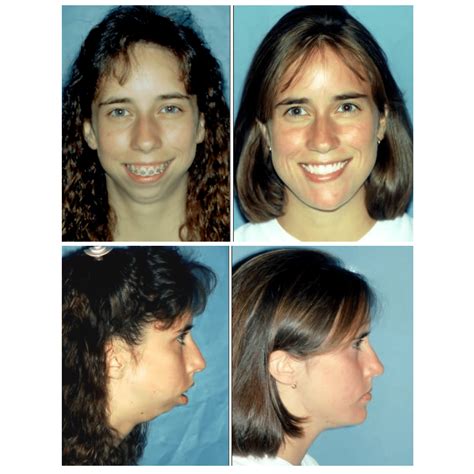 Before And After Surgery Photos Dr Larry M Wolford Dmd