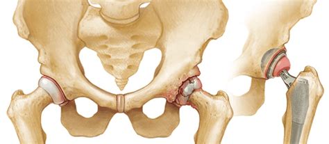 Understanding Hip Replacement Types Candidates And Procedures