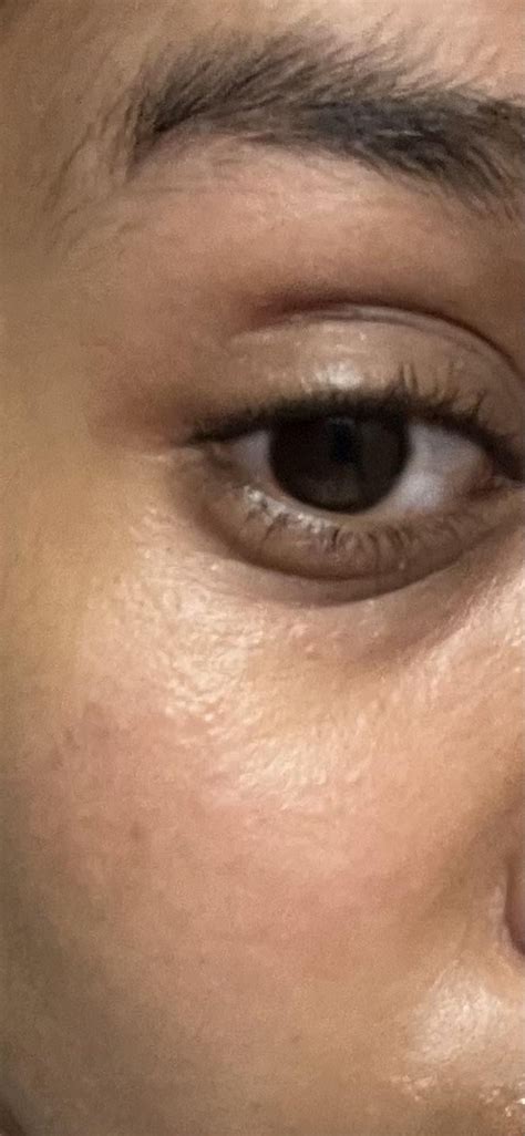 Itching Face Rashes Around Eye Racne