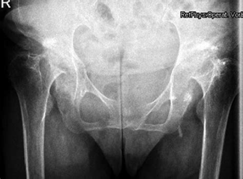 Protrusio Acetabuli Wikiprojectmed