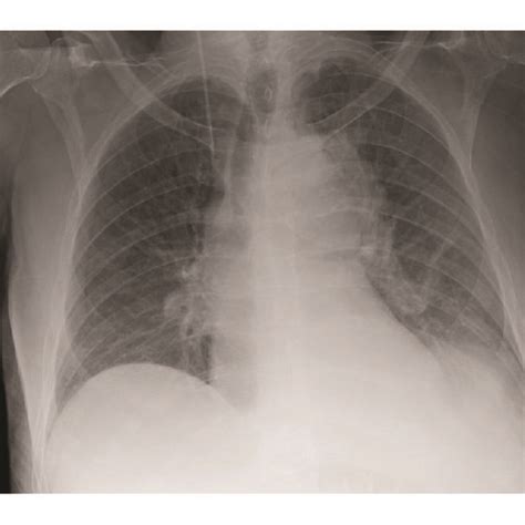 Ct Chest Sagittal View Showing Emphysematous Aortitis Download
