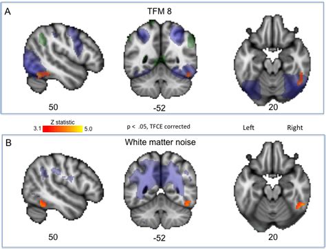 8 Abnormal Connectivity Of Right Inferotemporal Cortex In Relation To Download Scientific