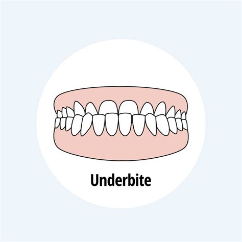 Invisalign For Underbites Dentist In Staten Island Ny