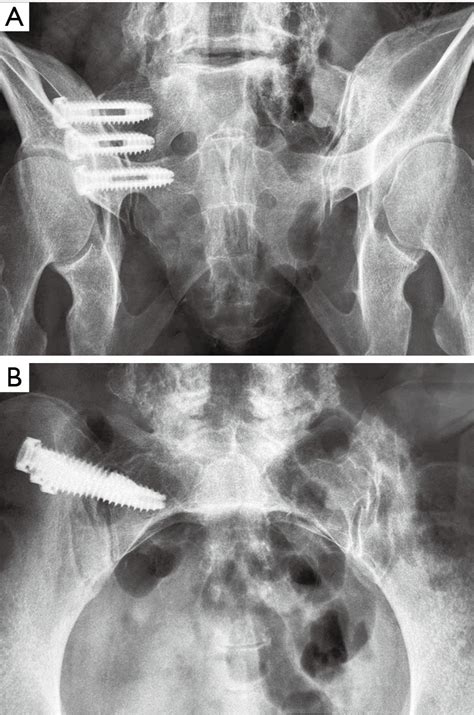 Minimally Invasive Sacroiliac Joint Fusion Using A Novel Hydroxyapatite Coated Screw Final 2