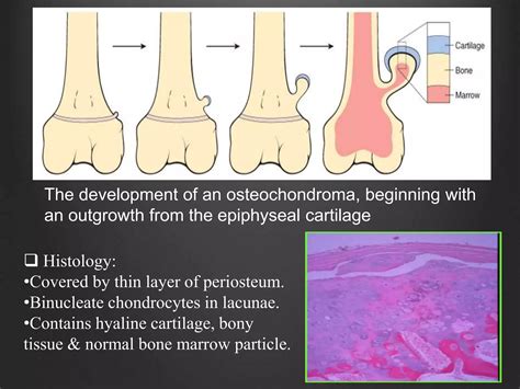 Osteochondroma Dr Mahesh Pptx