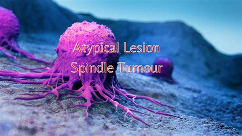 Atypical Lesion Spindle Tumour Dr Anthony Maloof