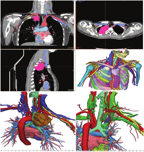 Three Dimensional Reconstruction Of Cervicothoracic Junction Tumour Download Scientific Diagram