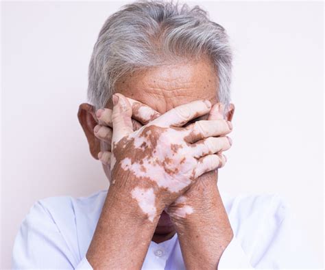 Vitiligo Variations Segmental Vitiligo And Non Segmental Vitiligo