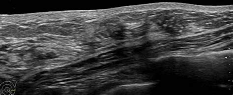 Breast And Axilla 5 2 Malignant Breast Lesions Case 5 2 2 Breast Carcinoma Diagnostic