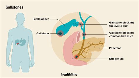 Gall Bladder Stone Symptoms Gall Stones To Operate Or Not To Operate