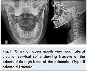 Anterior Odontoid Screw Fixation For Type Ii Odontoid Fracture