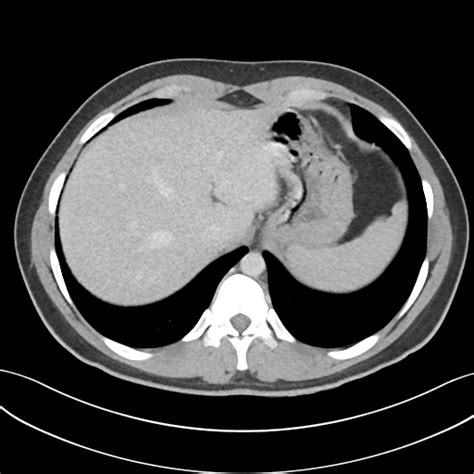 Acute Appendicitis With Appendicoliths Radiopaedia 50186 55532 Axial