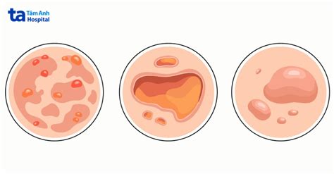 Pemphigus Bóng Nước Tự Miễn Nguyên Nhân Triệu Chứng điều Trị