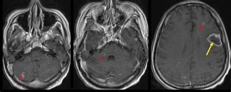 Septic Embolic Encephalitis Radiology Cases