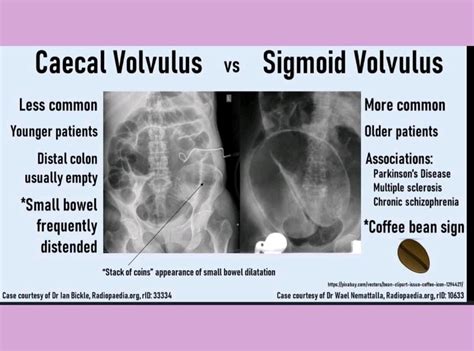 Cecal Vs Sigmoid Volvulus Dr Mati Ul Haq