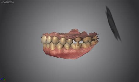 Metalodont Laboratoire De Prothèse Dentaire • Inlaycore Numérique