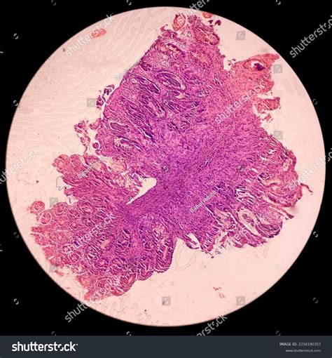 Sigmoid Coloncolonoscopic Biopsy Chronic Nonspecific Colitis Stock