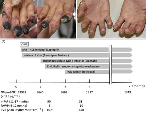 Journal Of Cutaneous Immunology And Allergy Vol 6 No 1
