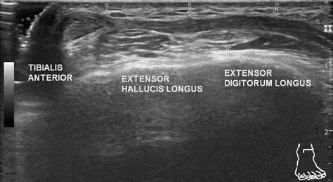 Radiopaedia Case Ankle Extensor Retinaculum And Lateral Ligaments
